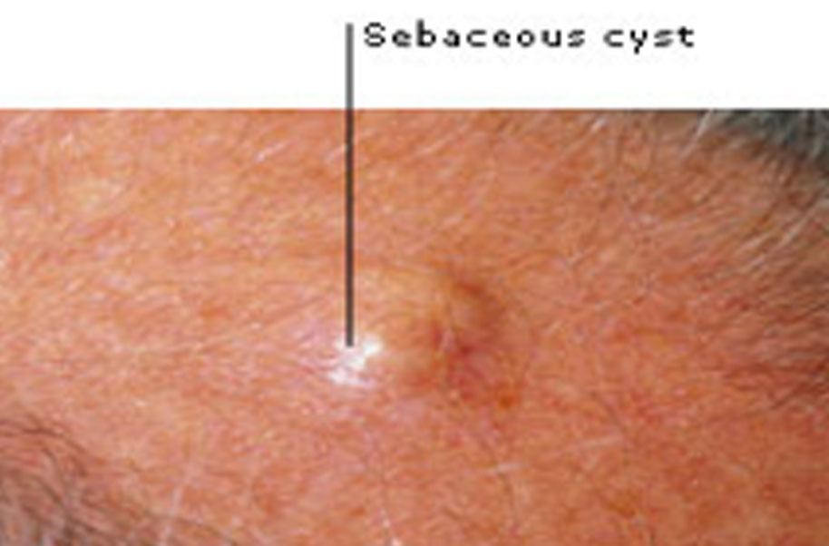 Pilar Cyst Pilar Cyst