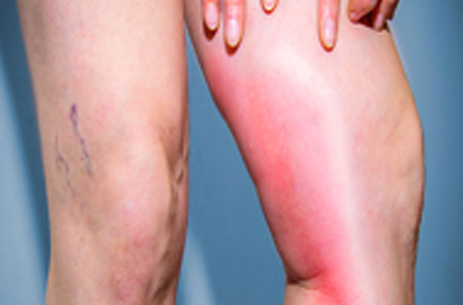 Deep Vein Thrombosis Blood Clot In The Leg 
