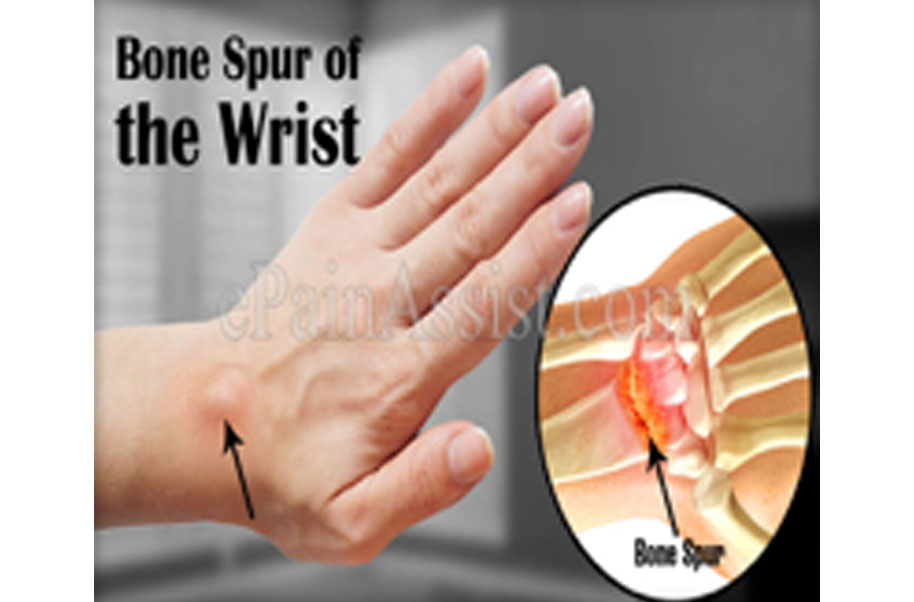 Bone Spurs Bone Spurs