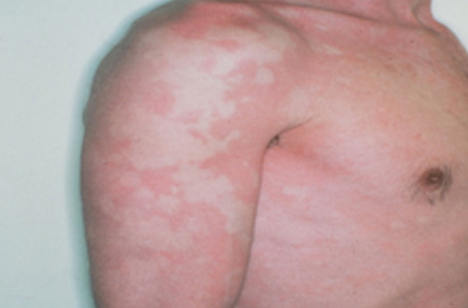 Carcinoid Syndrome Carcinoid Tumour 