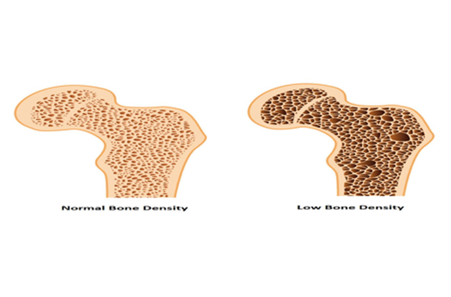 Brittle Bone Disease Brittle Bone Disease