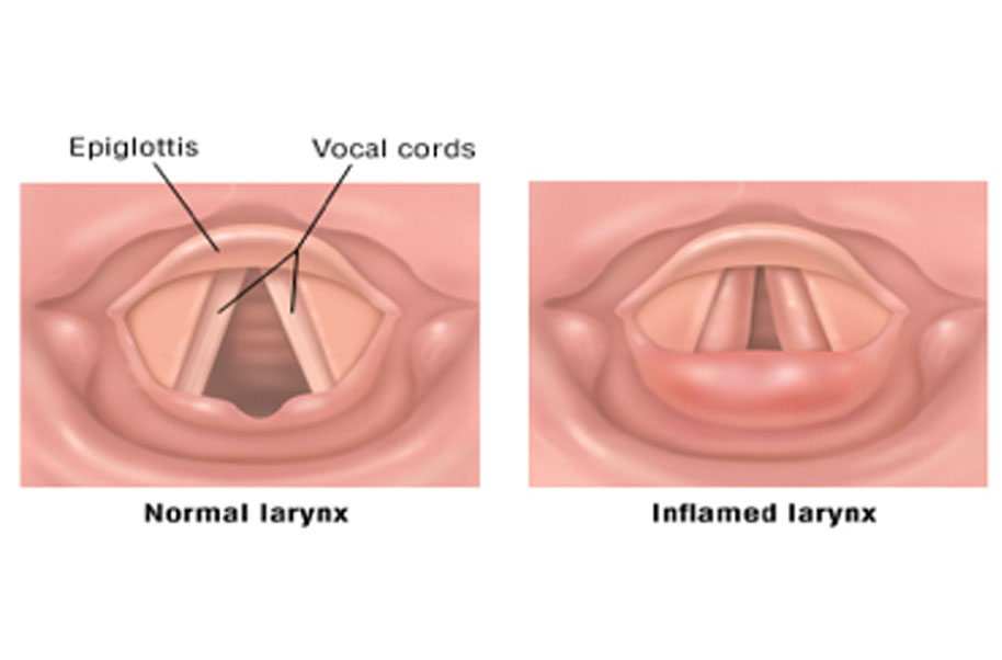 Chronic Laryngitis Chronic Laryngitis