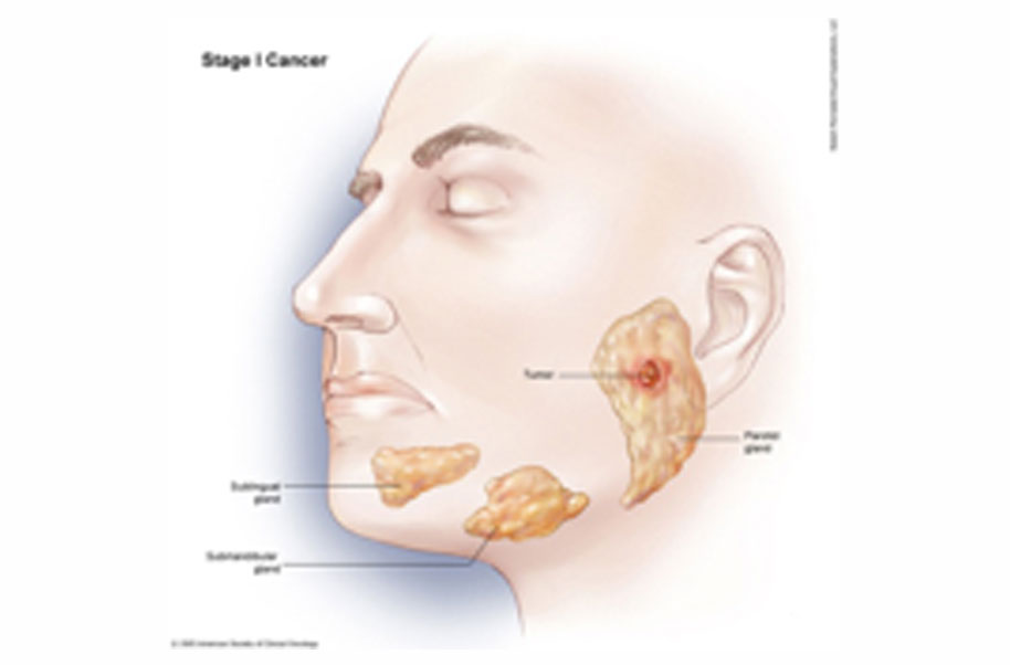 Salivary Gland Tumor Salivary Gland Tumor