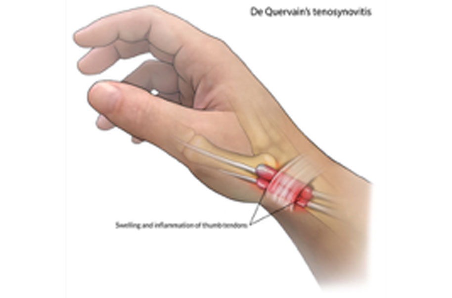 De Quervain s Tenosynovitis De Quervain s Tenosynovitis
