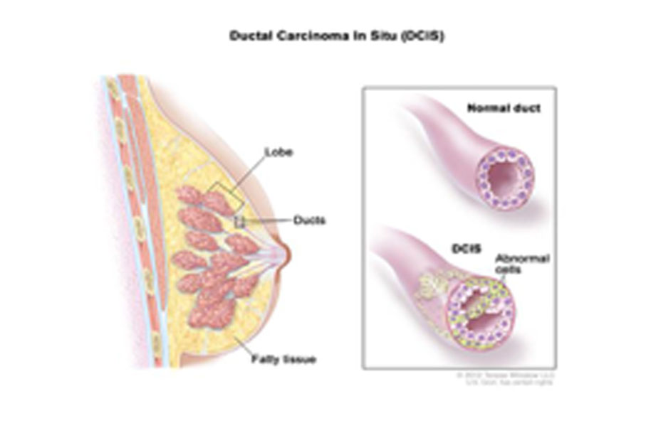 Invasive Ductal Carcinoma