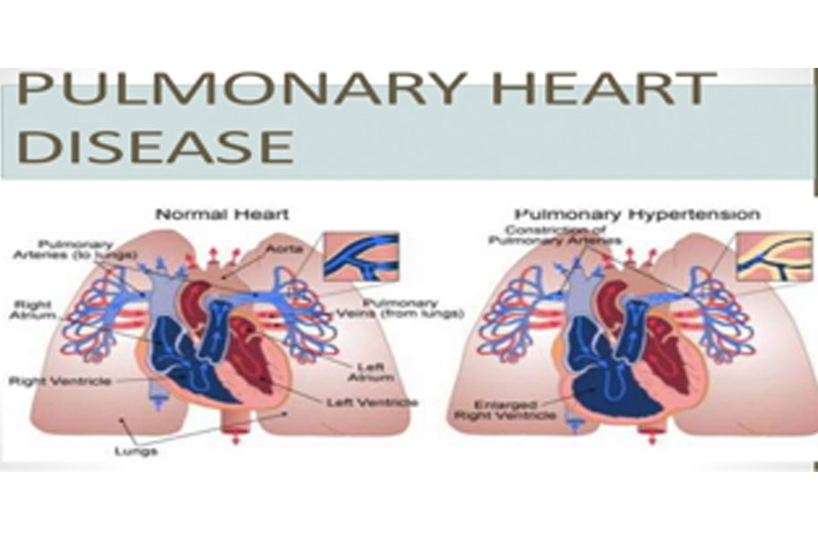 Cor Pulmonale Disease